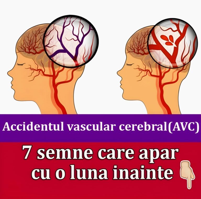 Accidentul vascular cerebral(AVC) este a 3-a cauza a decesului: cele 7 ...